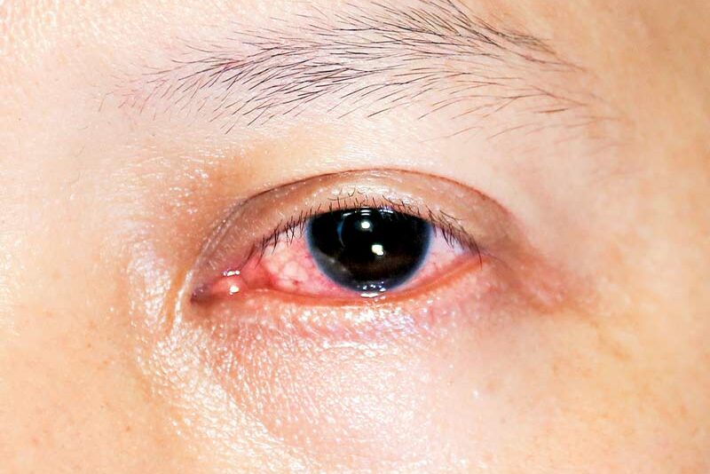 Conjunctivitis - RobinAge