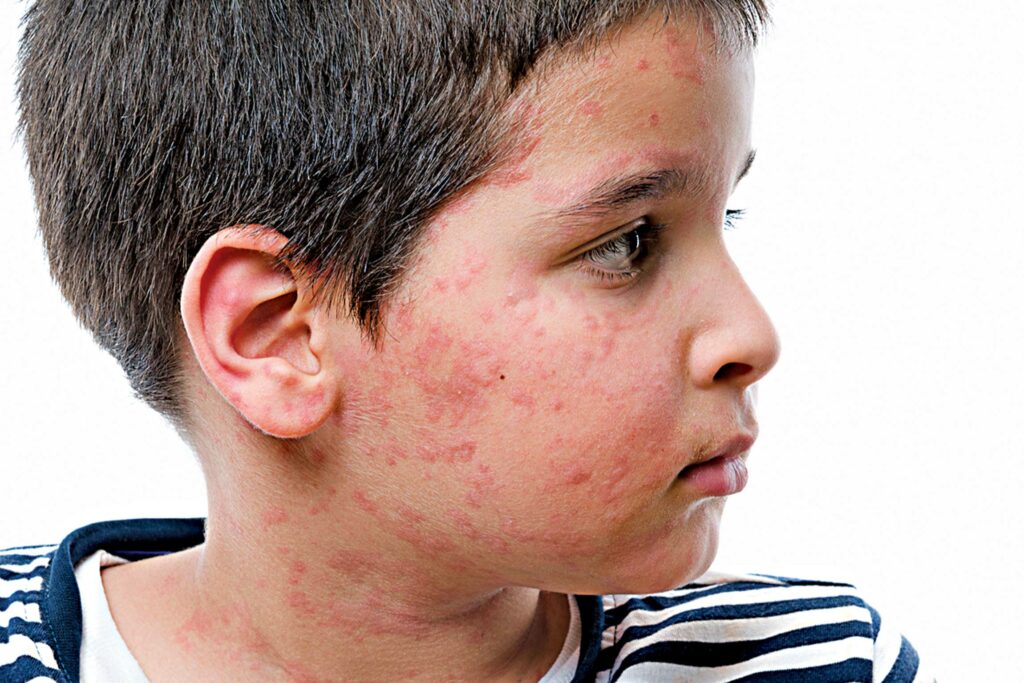 Measles Outbreak: Key Facts - RobinAge